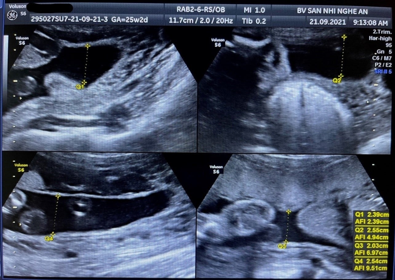 Loạn sản thận đa nang (Multicystic Dysplastic Kidney-MCDK) | Khoa học ...